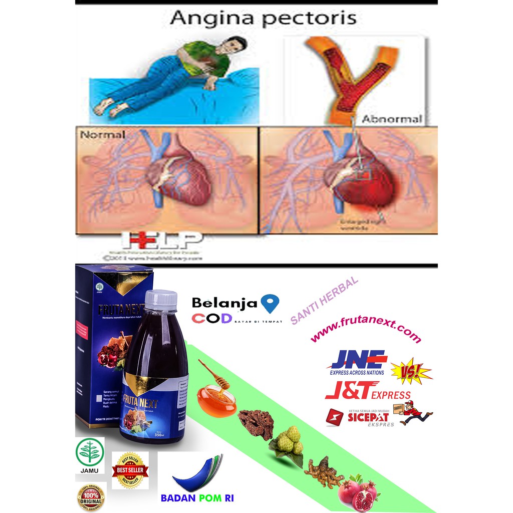 Jual Cara Mengobati Angin Duduk- Penyakit Angina - Obat Nyeri Dada ...