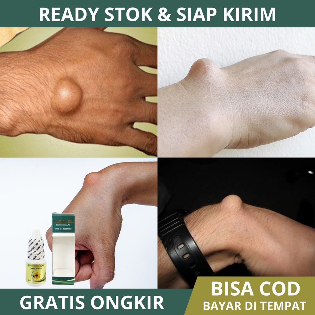 Jual Obat Kista Ganglion, Penghancur Benjolan Ganglion, Benjolan Lipoma ...