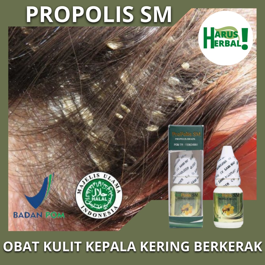 Jual PROPOLIS SM Obat Kulit Kepala Berkerak, Obat Psoriasis, Obat Kulit Kepala Kering, Obat ...