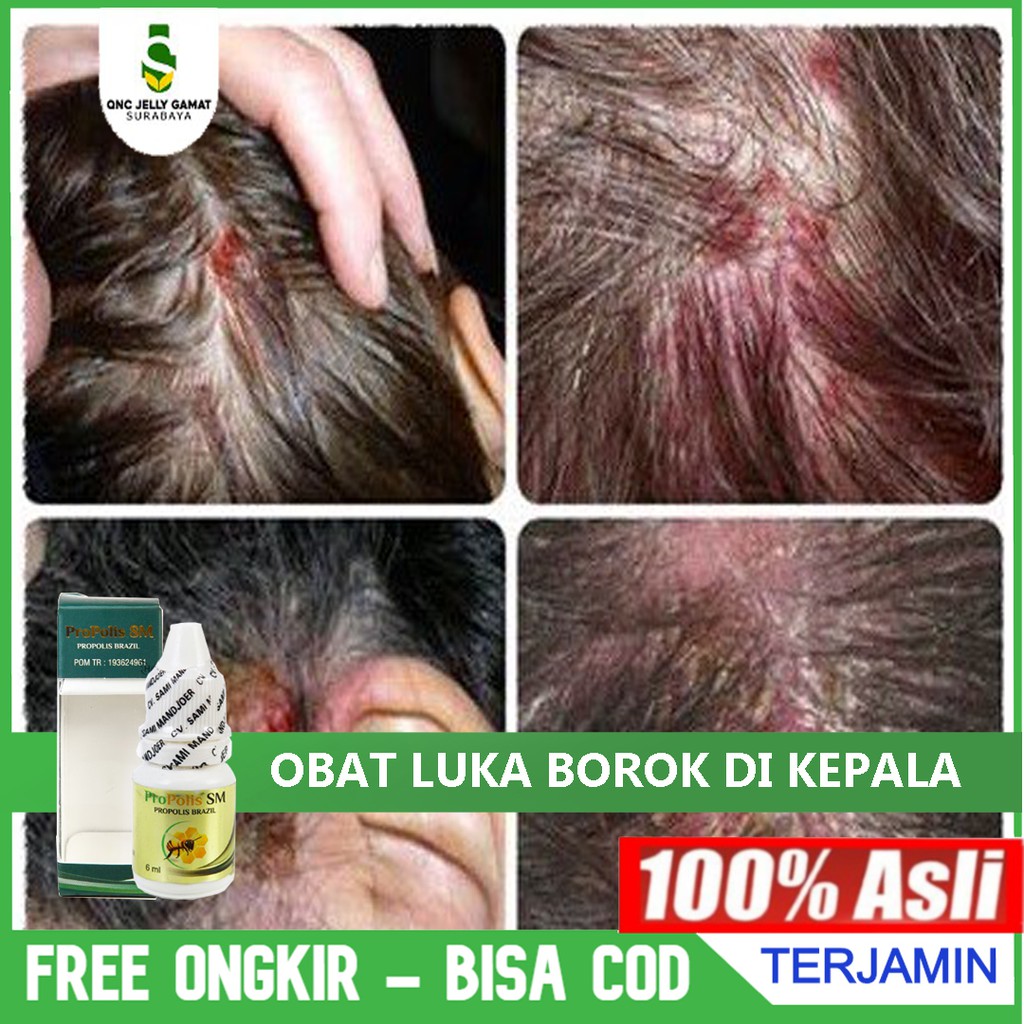 Jual Obat Luka Borok di Kepala, Borok Bernanah di Kepala Herbal Propolis SM Original - Bisa COD ...