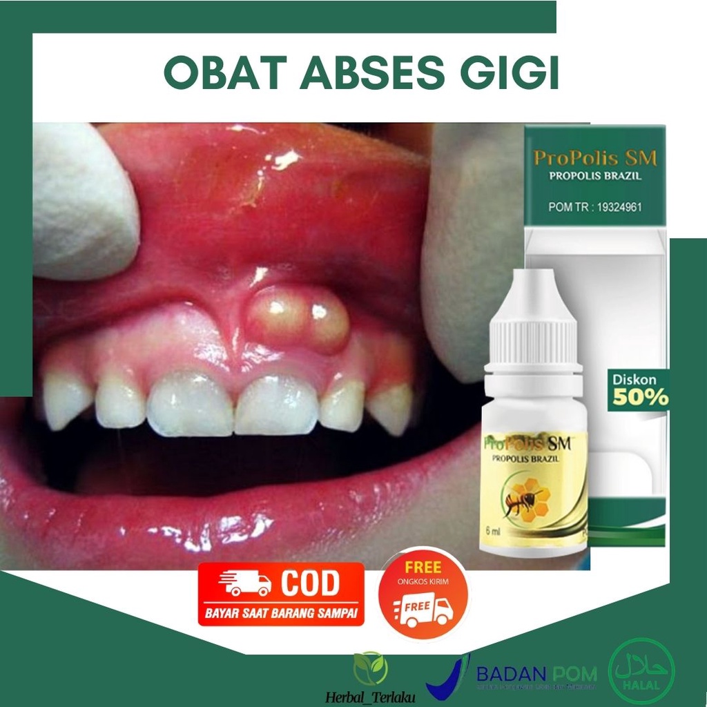 Jual Obat Abses Gigi , Gusi Bengkak , Benjol Bernanah , Gigi Sensitif ...