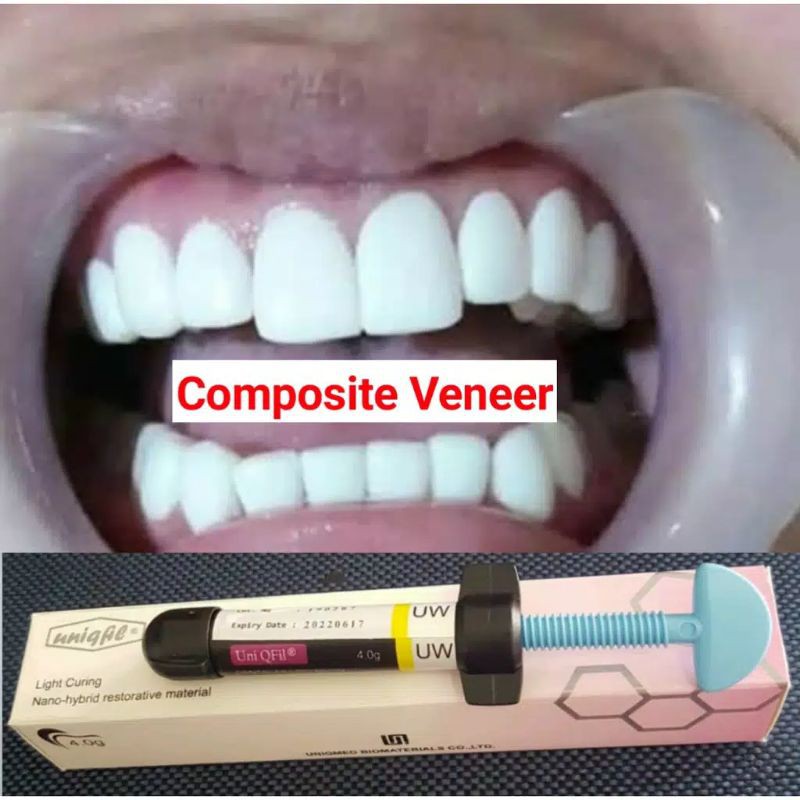 Jual Composite VENEER ultra white / LEM VENEER | Shopee Indonesia