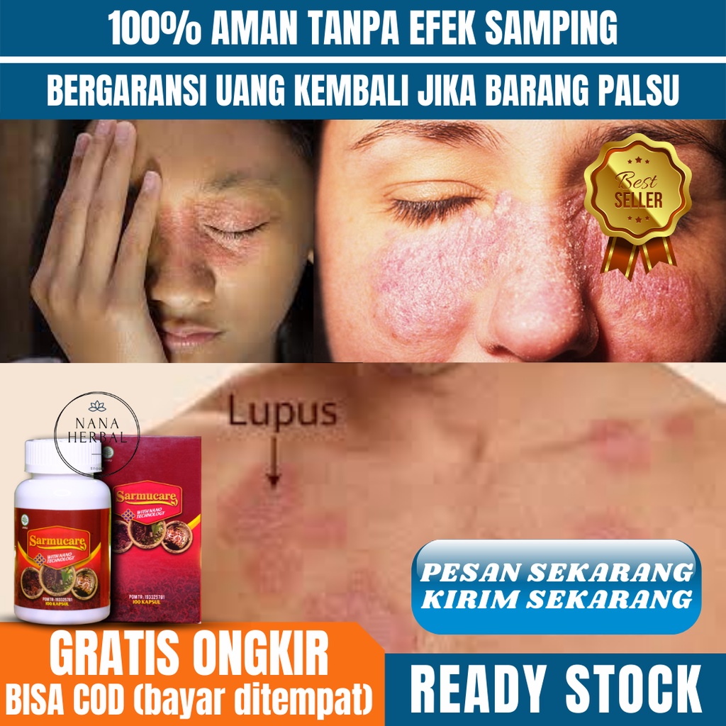 Jual Obat Lupus, Obat Autoimun Kronis, Obat Sistem Kekebalan Tubuh ...