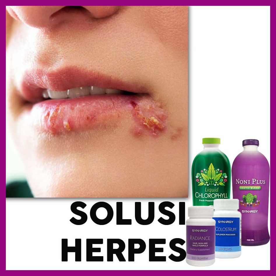 Jual Obat Cacar Api / Herpes Paket Herbal Paling Manjur Bahan Alami ...