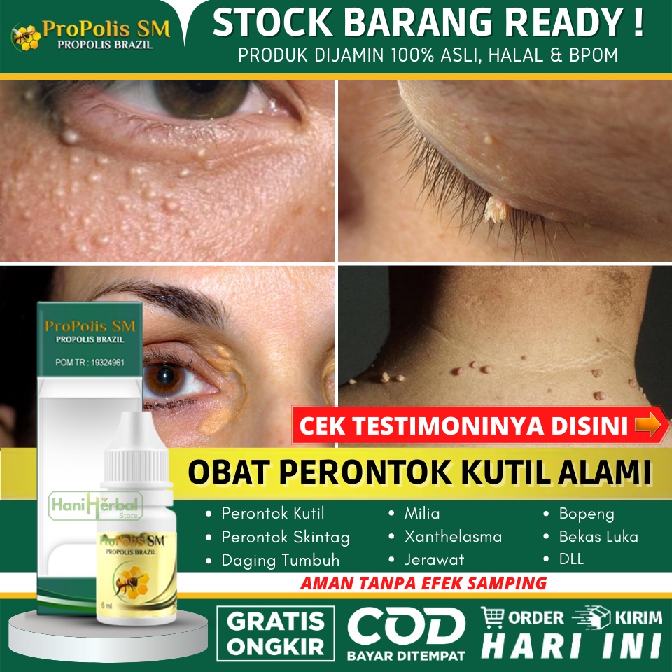 Jual Obat Kutil Verruca/Kutil Veruka/Penghilang Kutil Biasa/Kutil ...