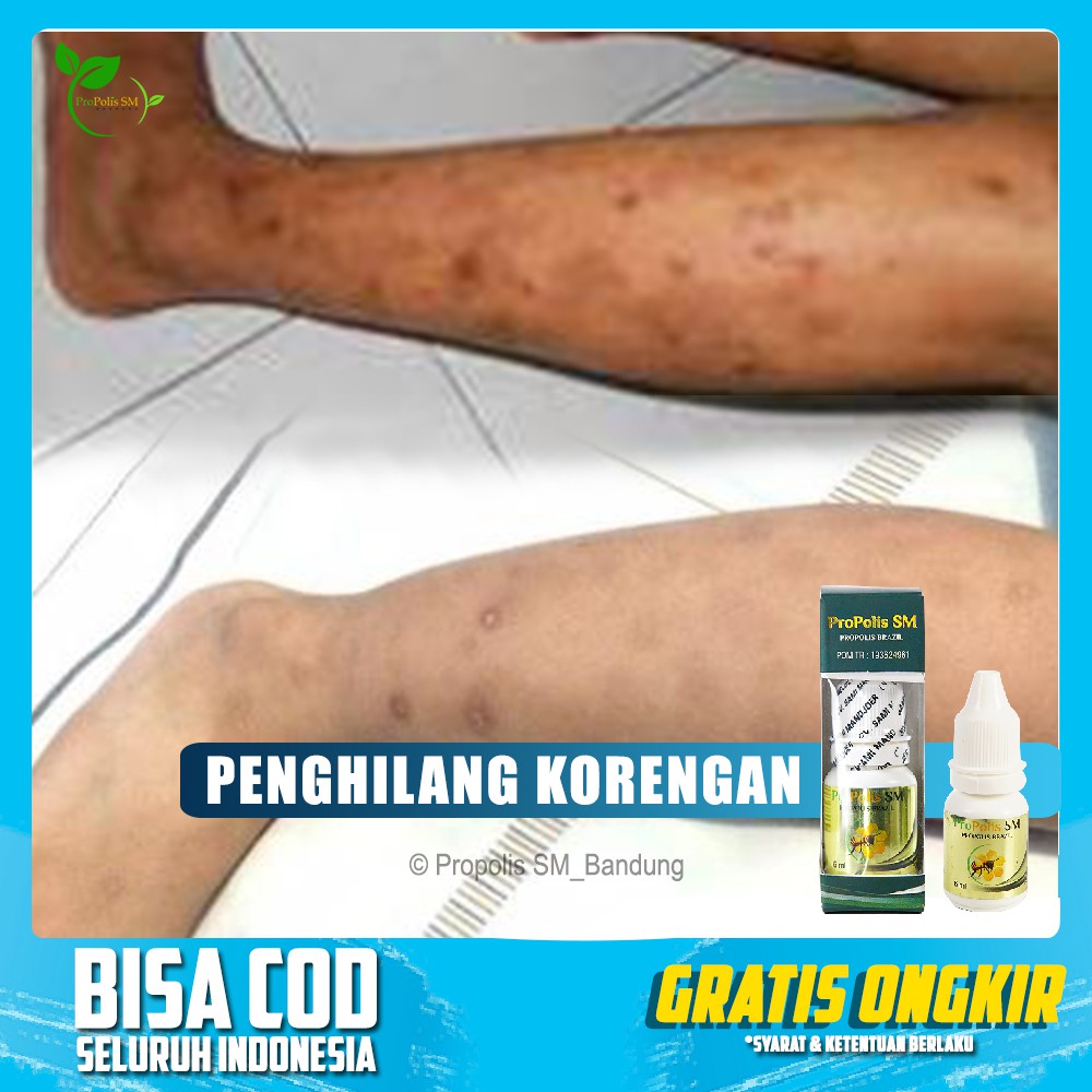 Jual Obat Koreng dikaki, Koreng ditangan, Penghilang Bekas Koreng ...