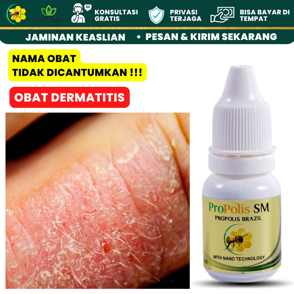 Jual Mitana Herbal - Obat Dermatitis Seboroik - Obat Dermatitis Atopik - Obat Dermatitis Kontak ...