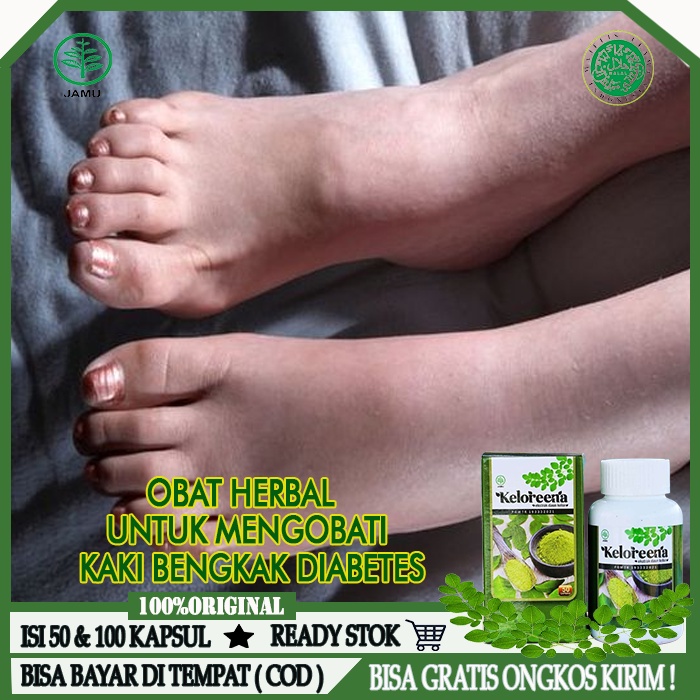 Jual Obat Kaki Bengkak Karena Diabetes, Obat Pengempis Kaki Bengkak ... Jual Obat Kaki Bengkak Karena Diabetes, Obat Pengempis Kaki Bengkak ...