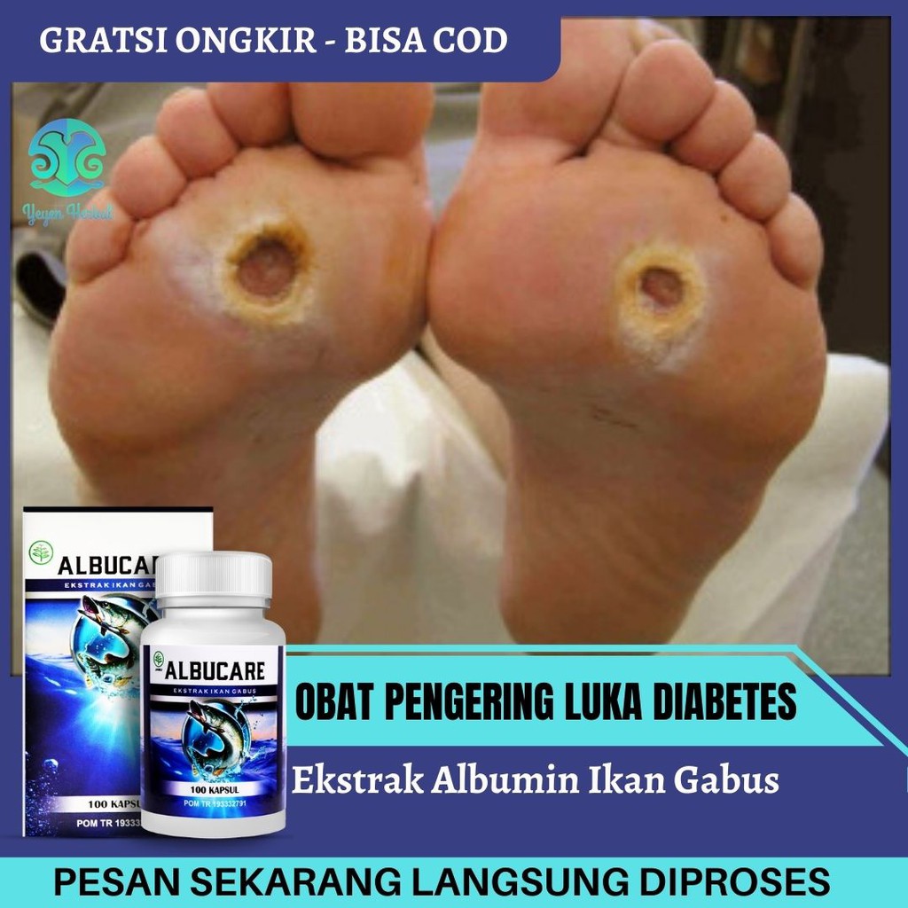 Jual Obat luka diabetes melitus, dibetes basah dan kering - ALBUCARE ...