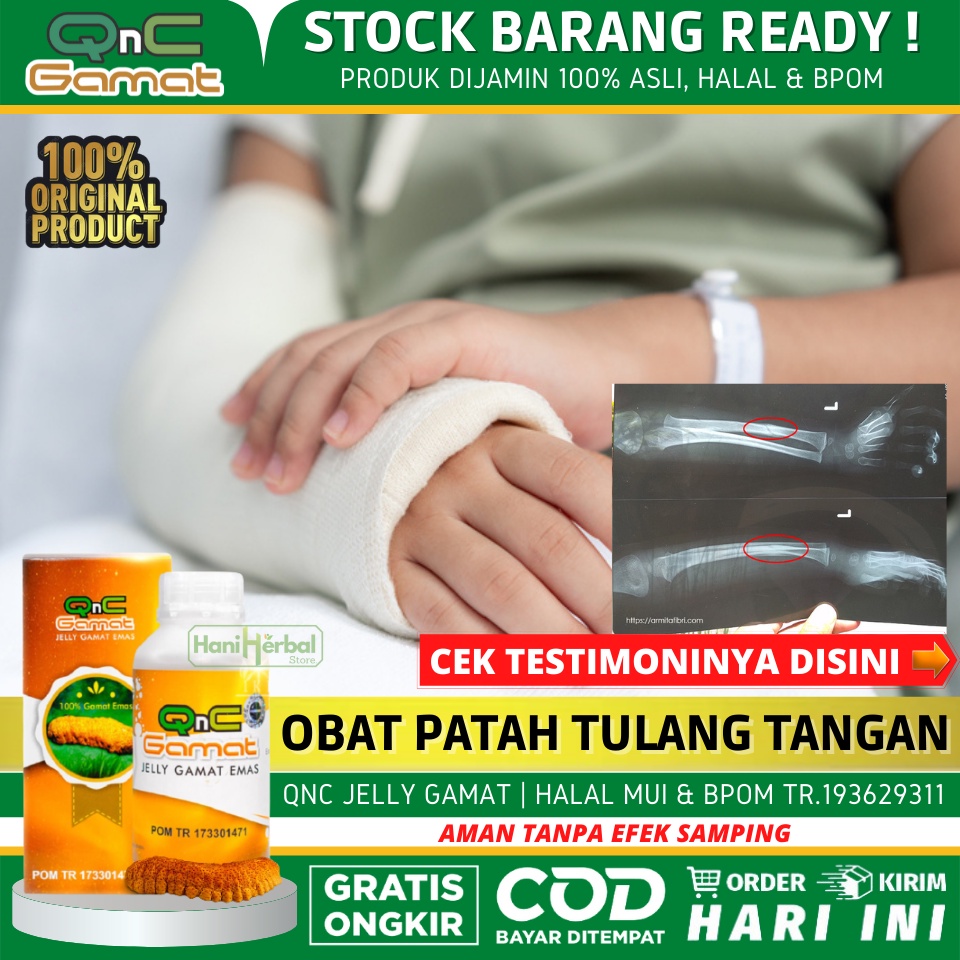 Jual Obat Patah Tulang Tangan Untuk Anak & Dewasa, Obat Patah ...
