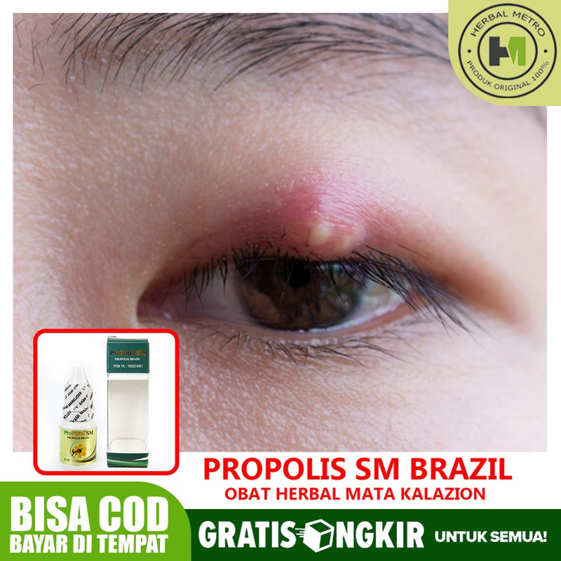Jual Obat Herbal Kalazion, Benjolan Kelopak Mata, Bintitan Propolis SM ...