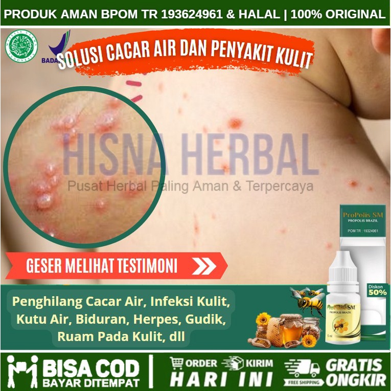 Jual Obat Tetes Cacar Air Pada Anak Dan Dewasa, Infeksi Kulit, Herpes ...