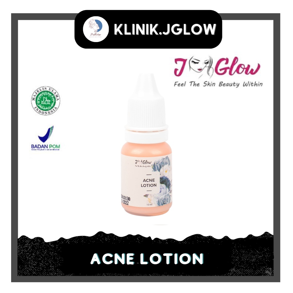 Jual J-GLOW - Acne Lotion - 10ml | Shopee Indonesia