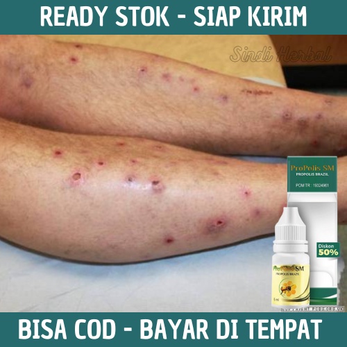 Jual Obat Darah Manis, Bentol, Prurigo, Penyakit Kulit, Kulit Gatal ...