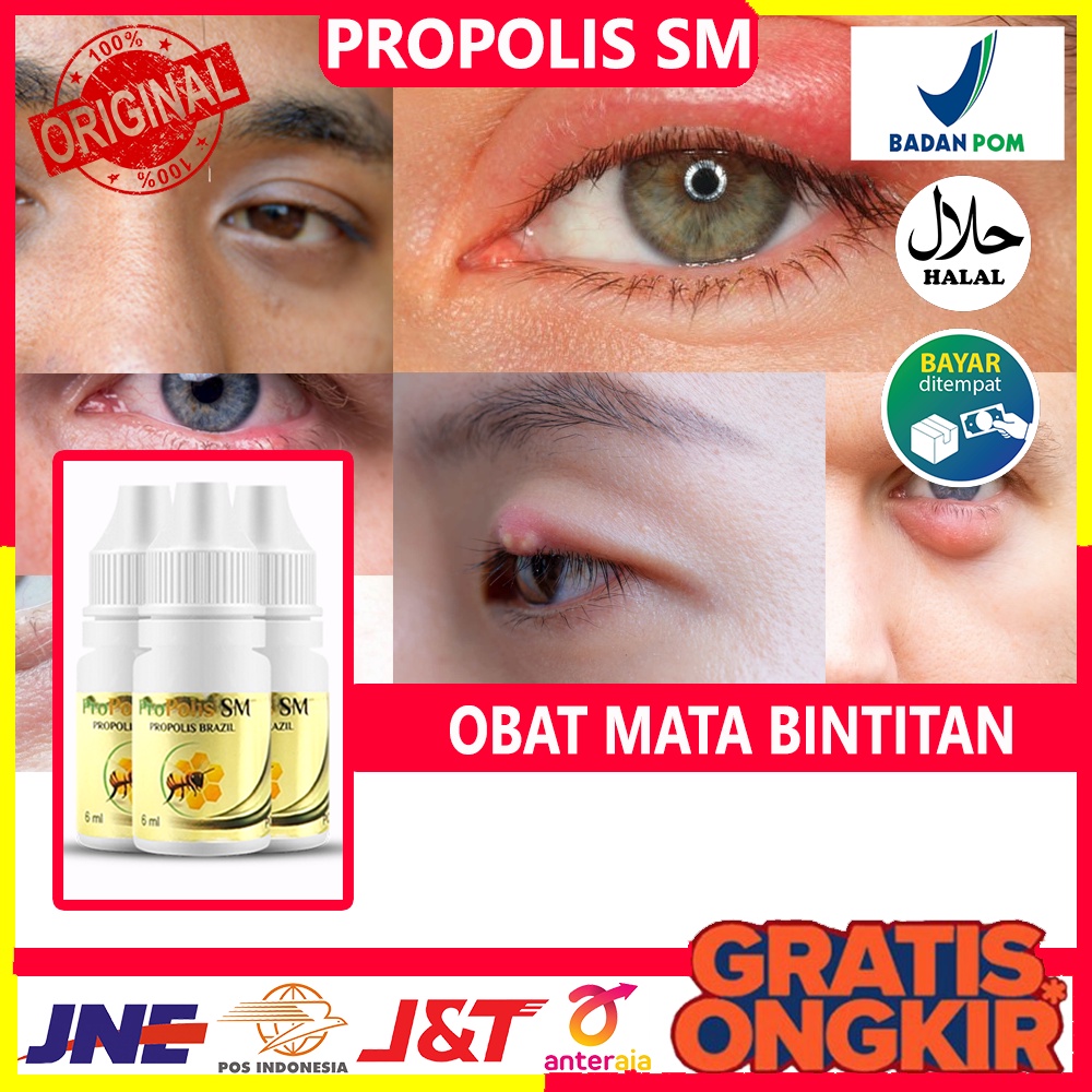 Jual Obat Mata Bintitan - Benjolan di Kelopak Mata - Kalazion - Mata ...