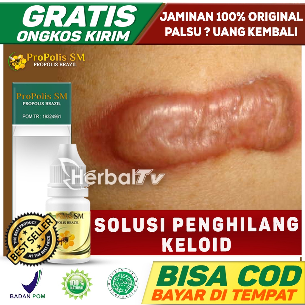 Jual Obat Keloid Herbal - Benjolan Menahun - Penghilang Daging Tumbuh Bekas Luka dan Bekas ...