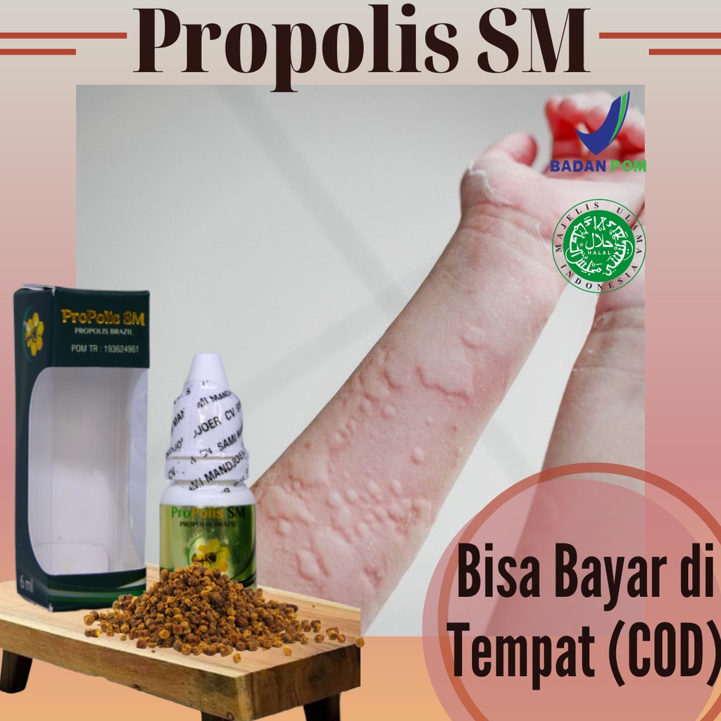 Jual Obat Biduran, Kaligata, Urtikaria, Eksim, Alergi Makanan, Alergi ...