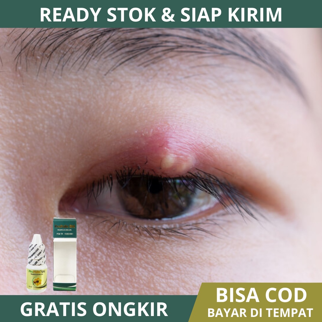 Jual Obat Penghilang Benjolan Kalazion, Mata Bintilan/Bintitan ...