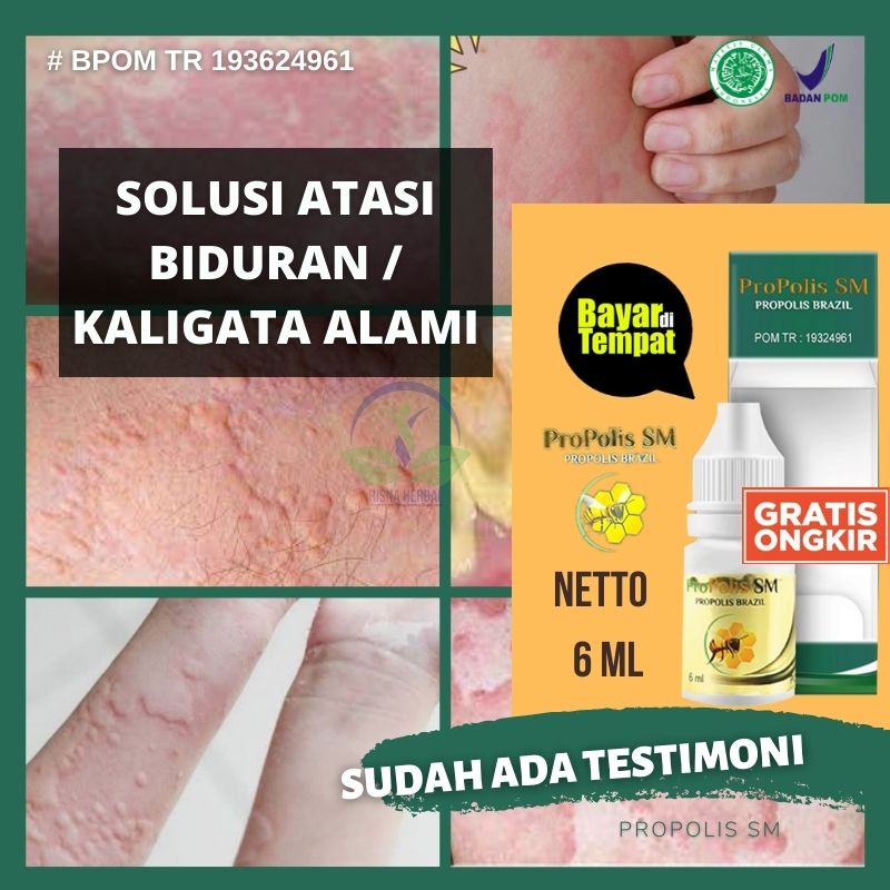 Jual OBAT BIDURAN DI WAJAH, MENGHILANGKAN GATAL KALIGATA DI MUKA, ANTI ...