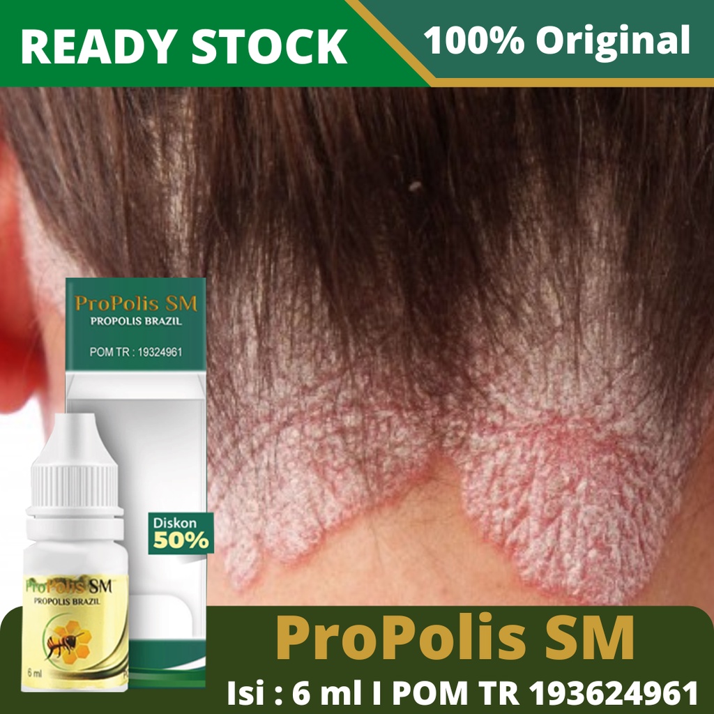 Jual Obat Penghilang Jamur di Kulit Kepala, Kulit Kepala Kering Dan Gatal, Koreng di Kepala ...