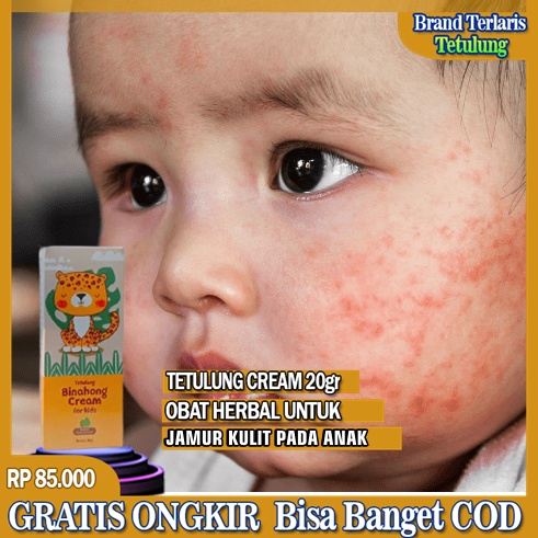 Jual Obat Jamur Ampuh Untuk Anak Dan Bayi Kadas Kurap Biang Keringat ...