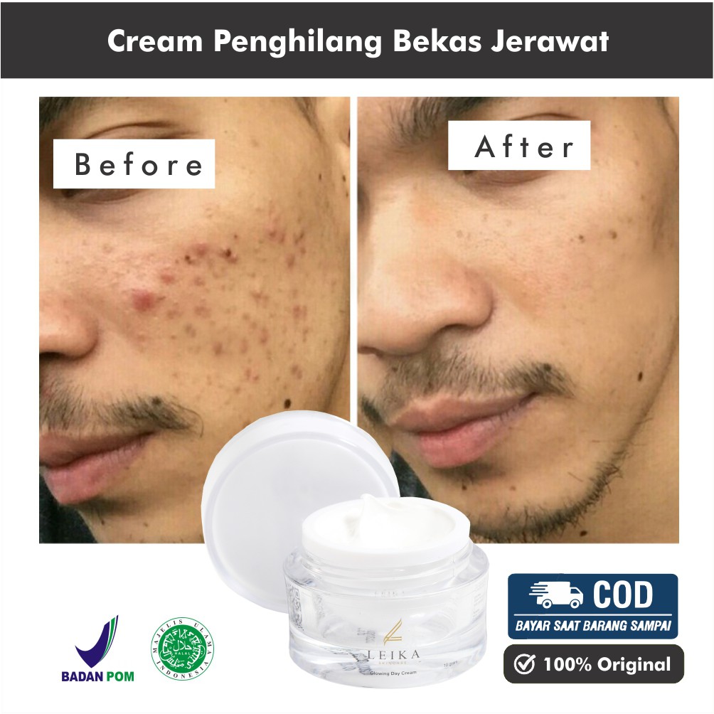 Jual PERMANEN!! Krim Penghilang Bekas Jerawat Hitam Pria Ampuh Secara Cepat Aman BPOM Cream ...
