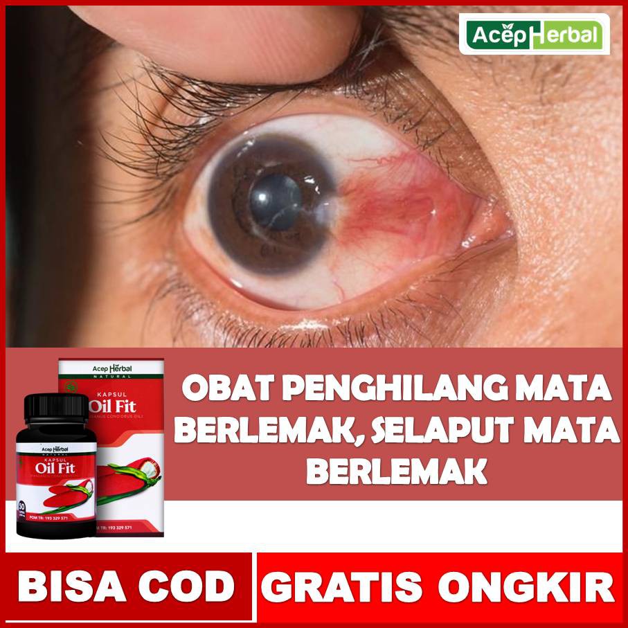 Jual OIL FIT - Spesialis Obat Mata Berlemak, Penghilang Mata Berlemak, Pembersih Selaput Mata ...