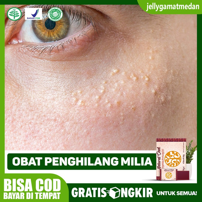 Jual Obat Penghilang Milia, Di Wajah, Milea, Bintik Di Muka Natural OUD ...
