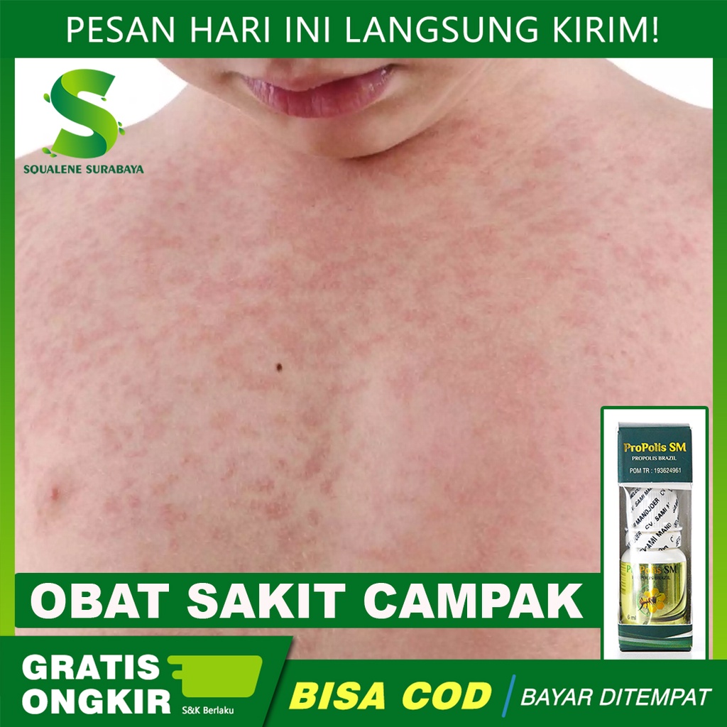 Jual Obat Sakit Campak - Badan Gatal-Gatal - Badan Alergi - Seluruh ...