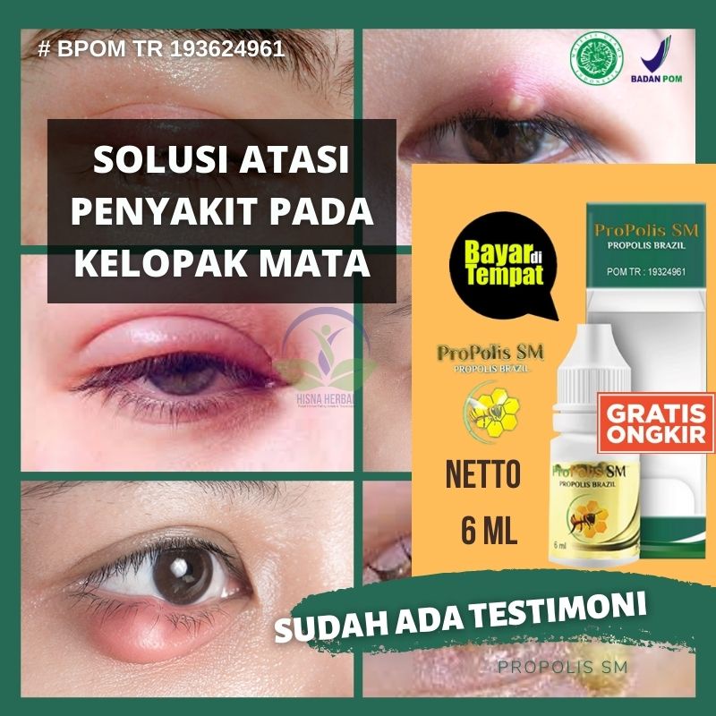 Jual OBAT PENGEMPIS BENJOLAN DI KELOPAK MATA - PENGHILANG BENJOLAN DI ...