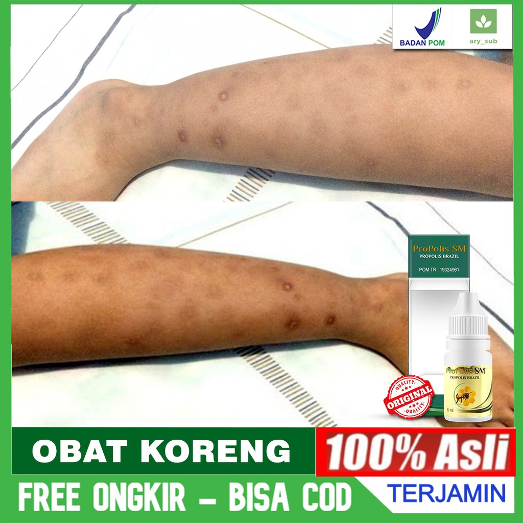Jual Obat Korengan di Kaki - Korengan di Kepala - Korengan di Wajah ...