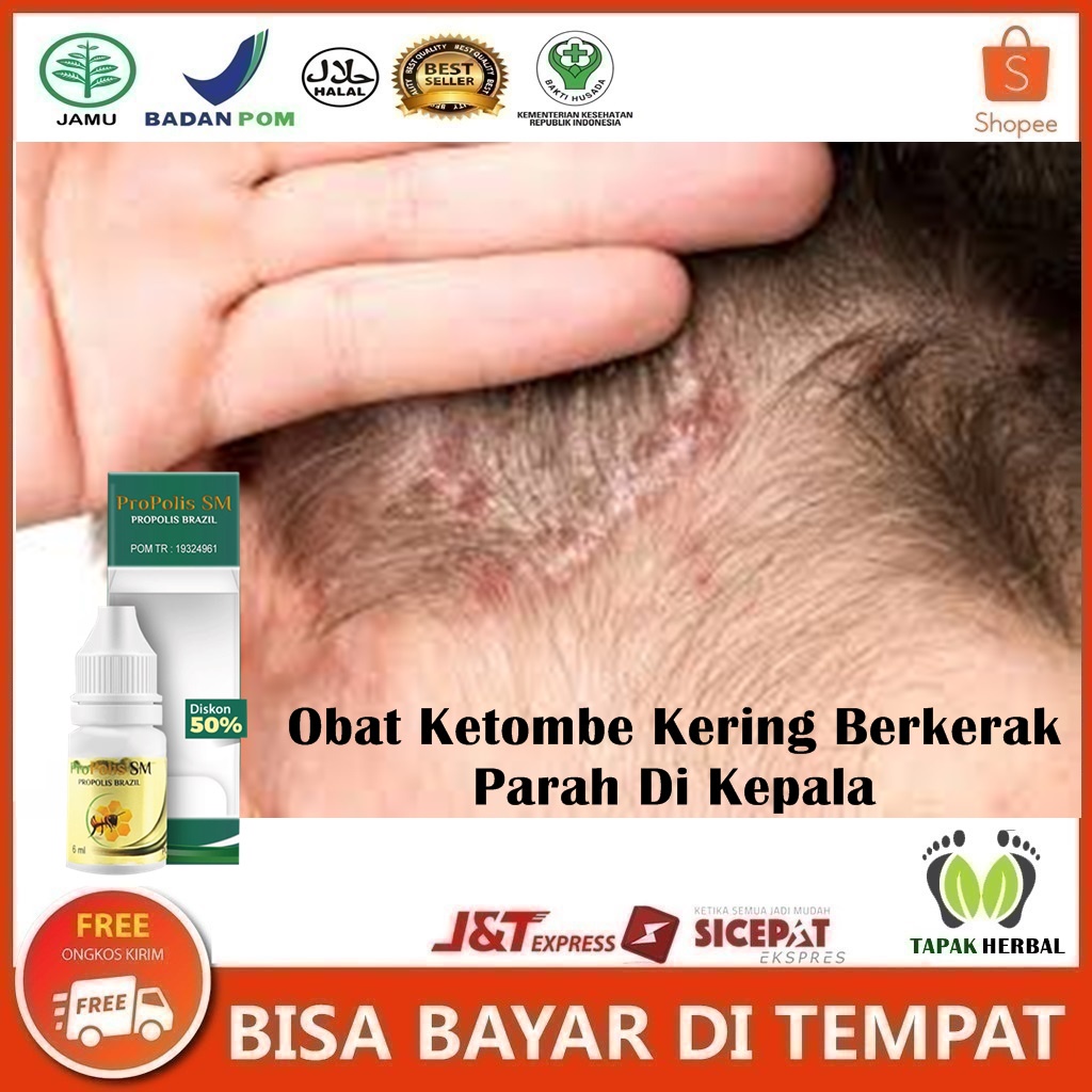 Jual Obat Oles Ketombe Kering Berkerak Parah Di Kepala, Penghilang Kulit Bersisik Gatal, Infeksi ...