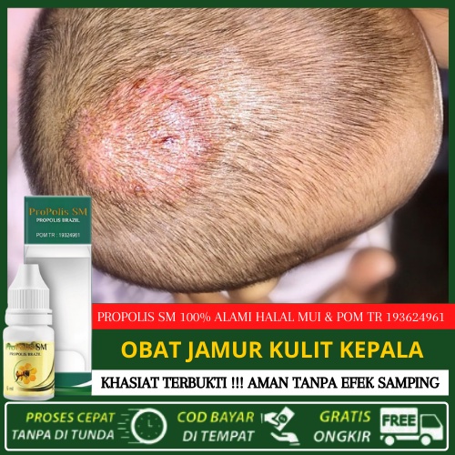 Jual Obat Tinea Capitis Jamur Kulit Kepala Anak Dan Dewasa Borok Korengan Kulit Kepala Berkerak ...