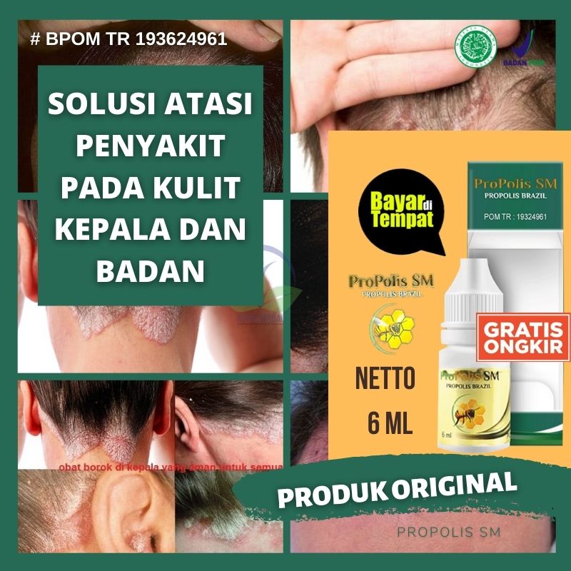 Jual Obat Ketombe Berkerak Herbal - Koreng di Kulit Rambut Kepala, Obat Kulit Kepala Bernanah ...