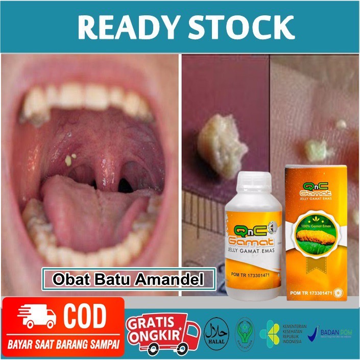 Jual Obat Batu Amandel, Obat Batu Tonsil, Bintik Putih Amandel - QnC ...