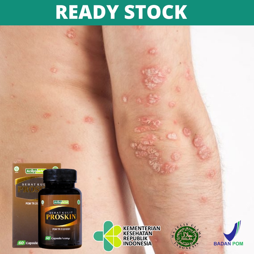 Jual Obat Gatal Kulit Psoriasis, Kulit Kering, Obat Kulit Bersisik dan ...
