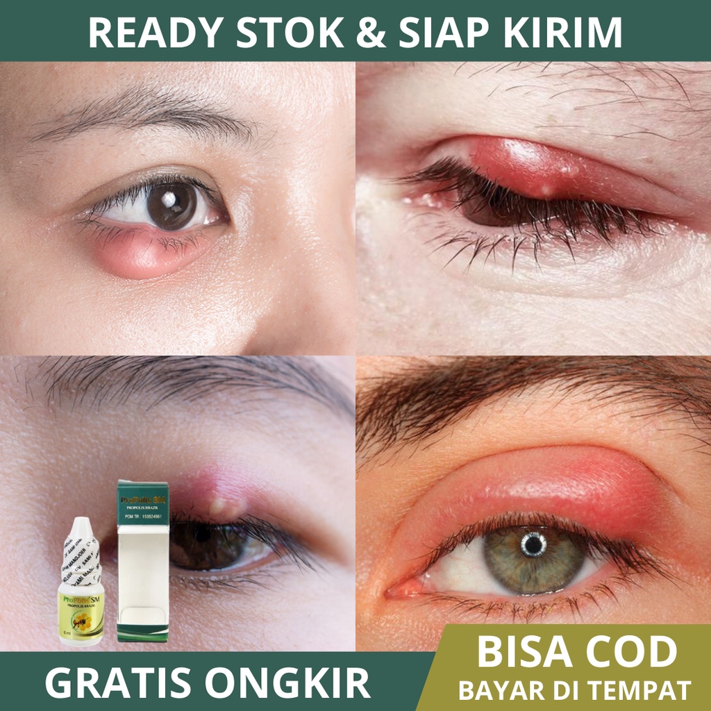 Jual Obat Mata Kalazion - Obat Penghilang Kalazion - Benjolan di ...