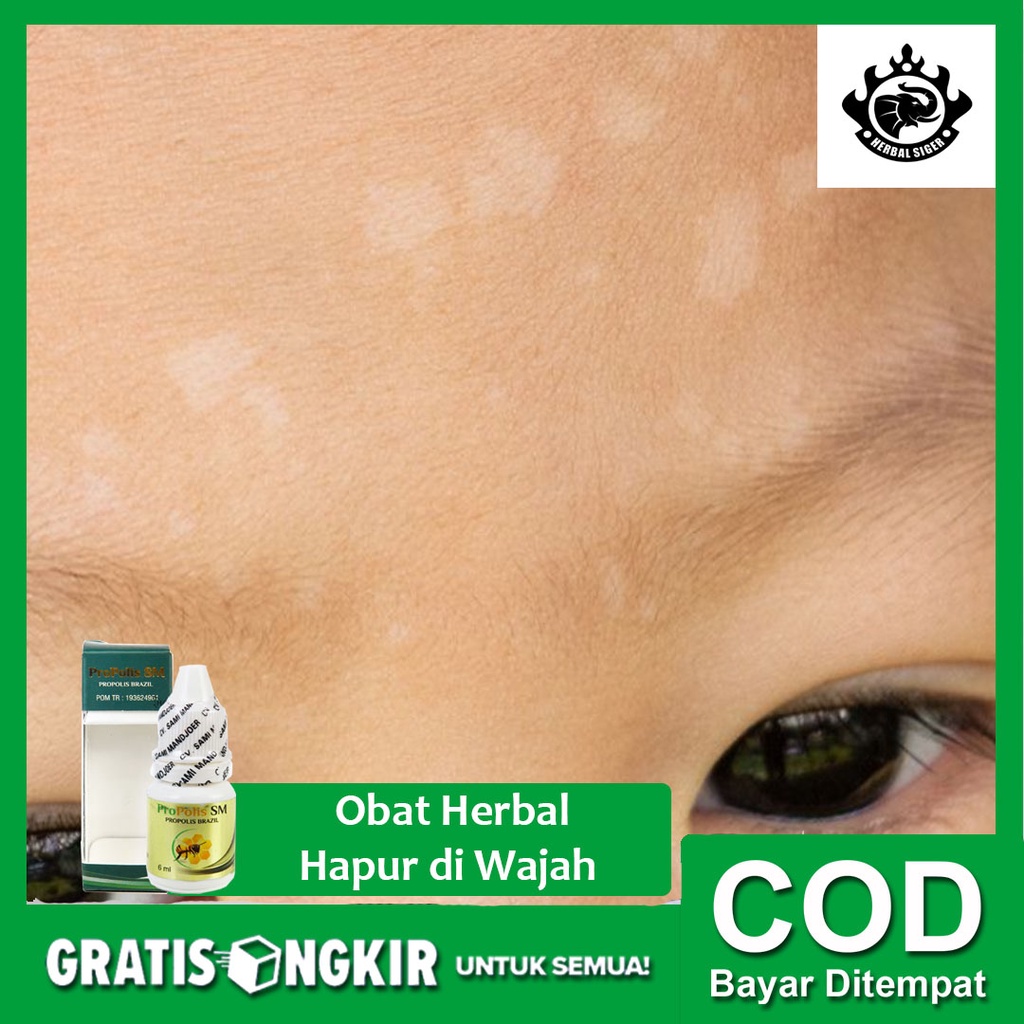 Jual Obat Herbal Hapur dan Panu di Wajah - Obat Bercak Putih di Wajah ...