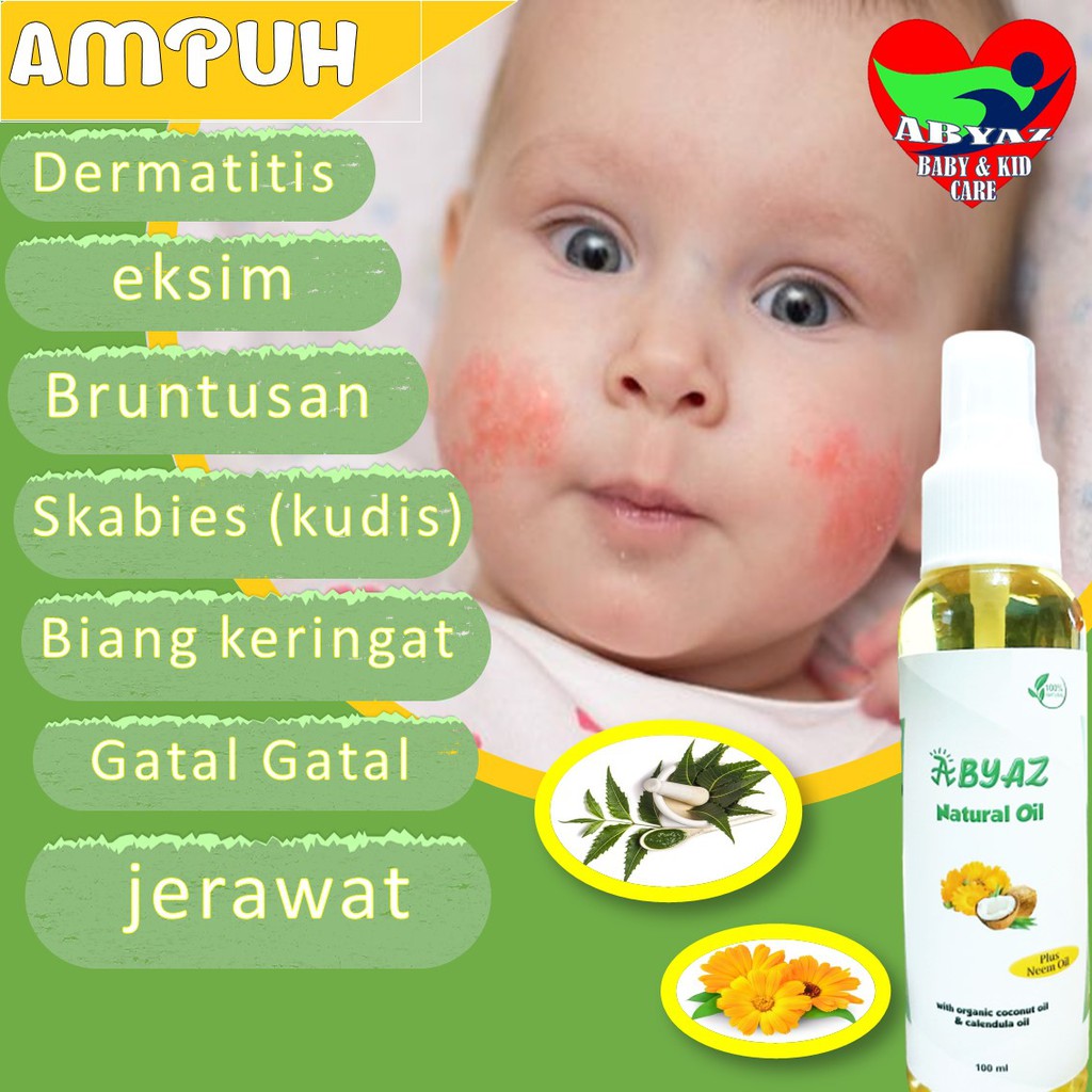 Jual OBAT SCABIES HERPES GATAL DERMATITIS EKSIM ALERGI ANTI INFLAMASI ...