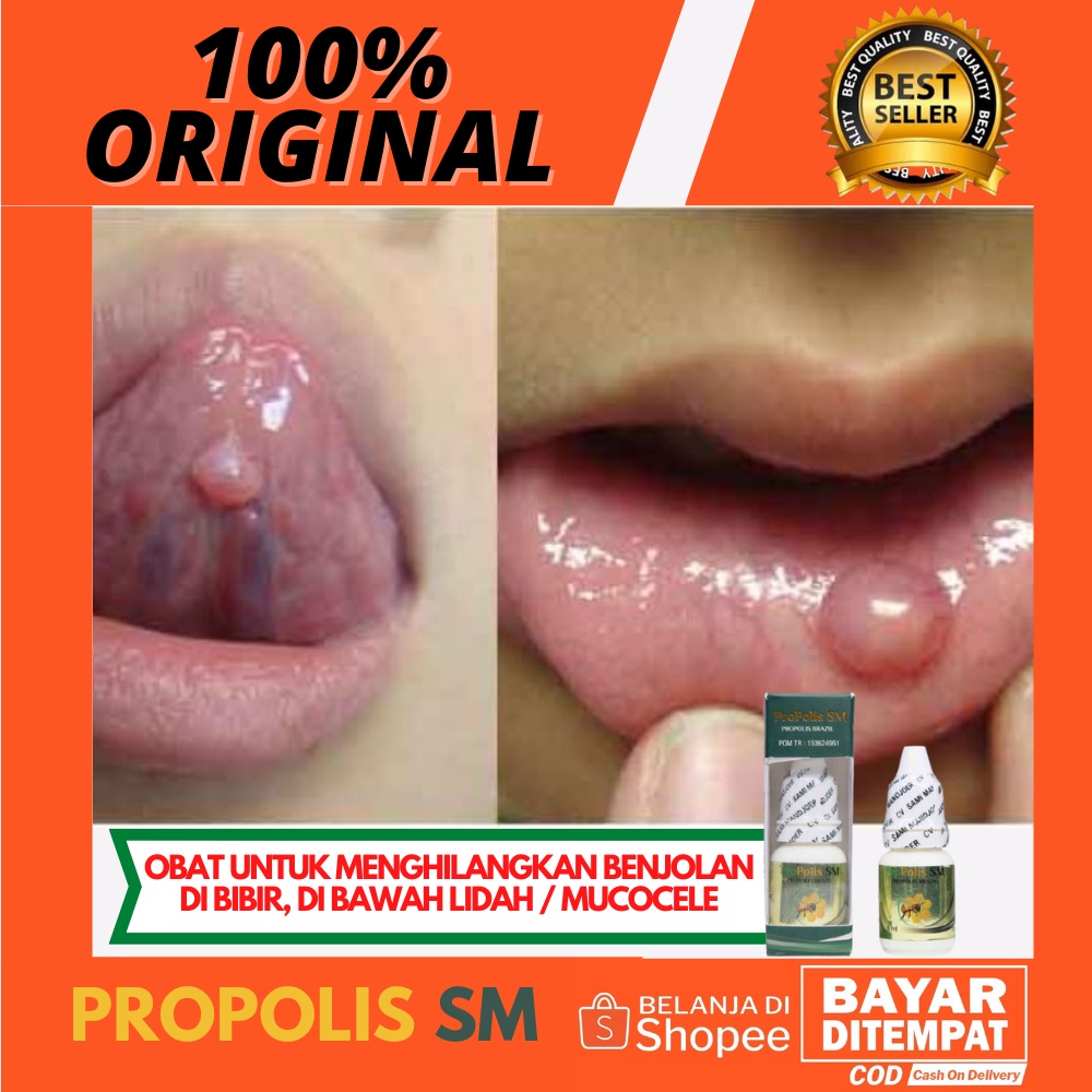 Jual Obat Mucocele, Obat Penghilang Mucocele, Obat Benjolan di Bibir ...