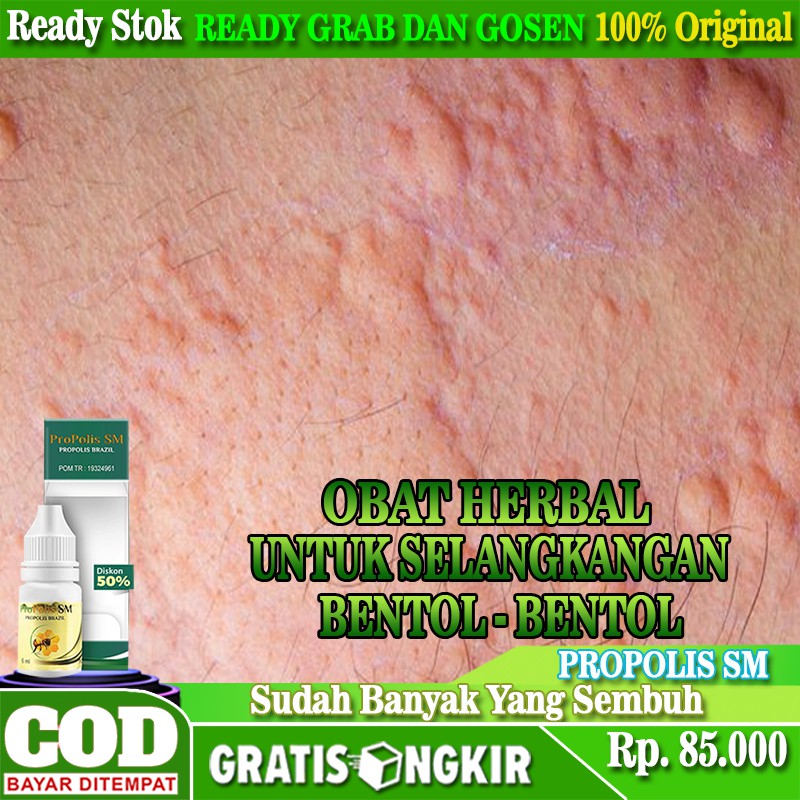 Jual Obat Bentol Bentol Di Selangkangan, Bentol Bentol Kecil Di ...