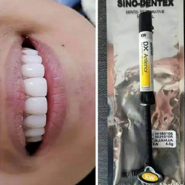Jual Dentex XW /EXW komposit dentex extra white / composite veener dentex | Shopee Indonesia