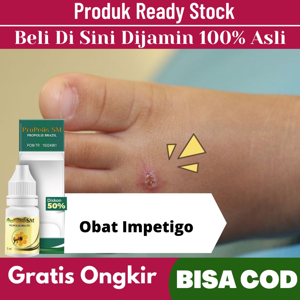Jual Obat Impetigo , Kurap , Cacr Air , Ruam Merah , Dermatitis Kontak ...