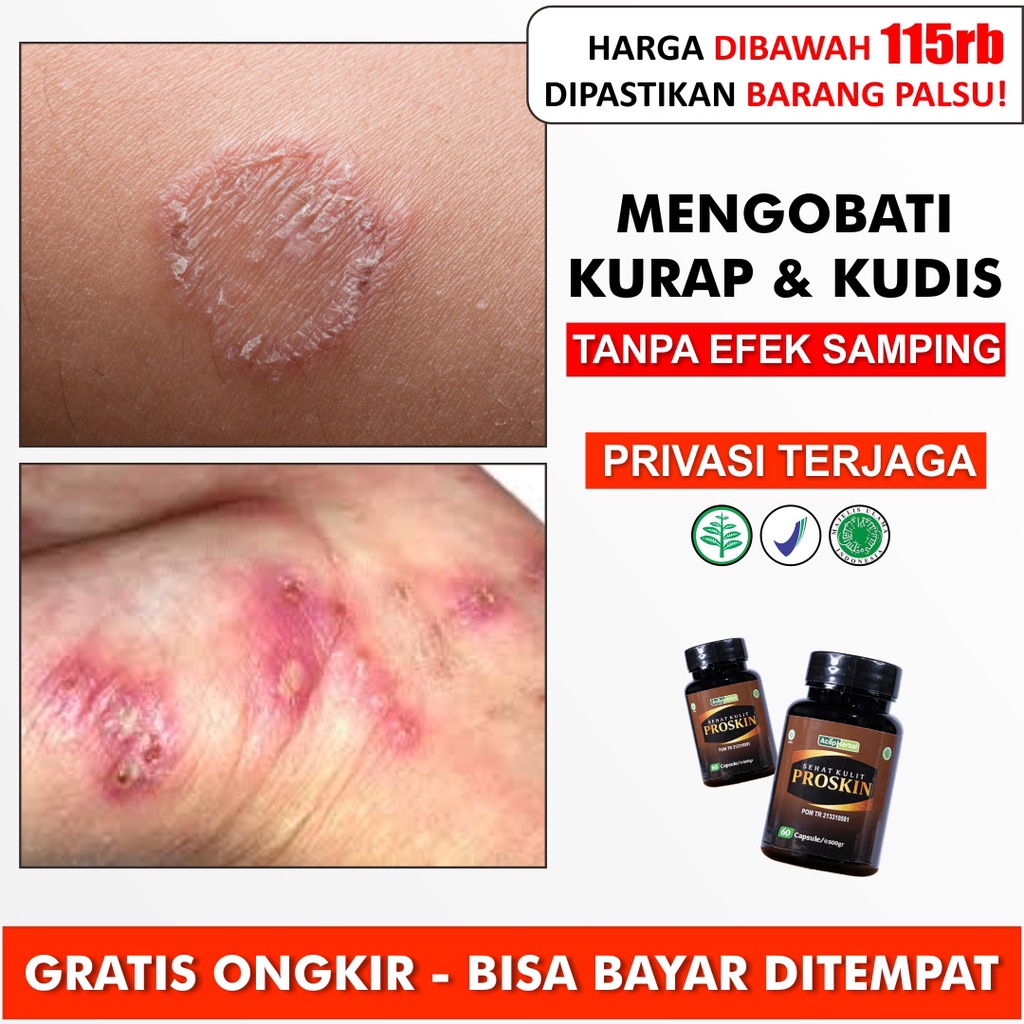 Jual Obat Kurap Kadas Kudis Hapur Panu Scabies Manusia Alergi Gatal ...