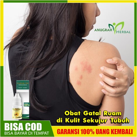 Jual Obat Gatal Ruam di Kulit Sekujur Tubuh | Herbal Penghilang Infeksi ...