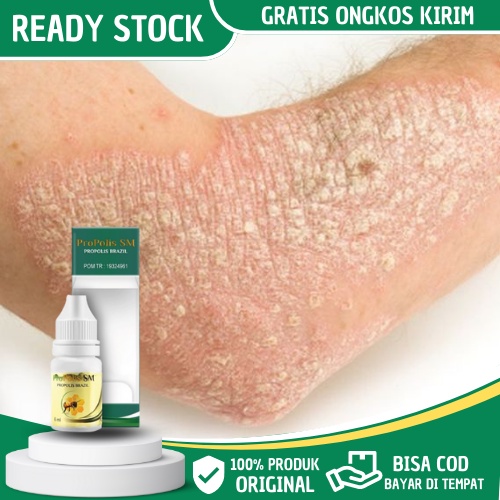 Jual Obat Gatal-Gatal Kadas Kurap Dengan Propolis SM Obat Gatal Jamur ...