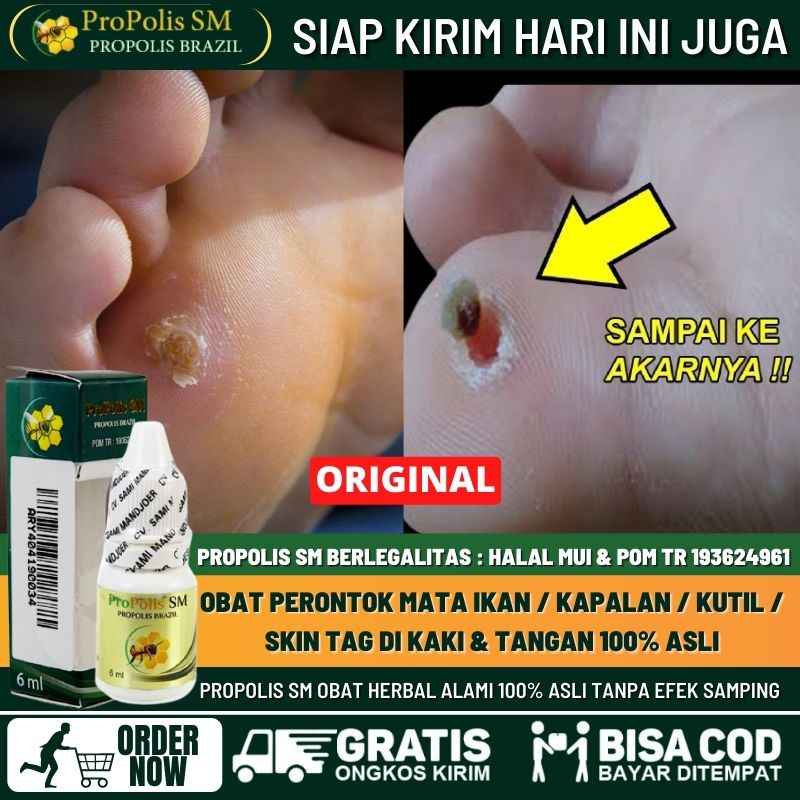 Jual Obat Tetes Perontok Mata Ikan di Telapak Kaki, Obat Kapalan Di ...