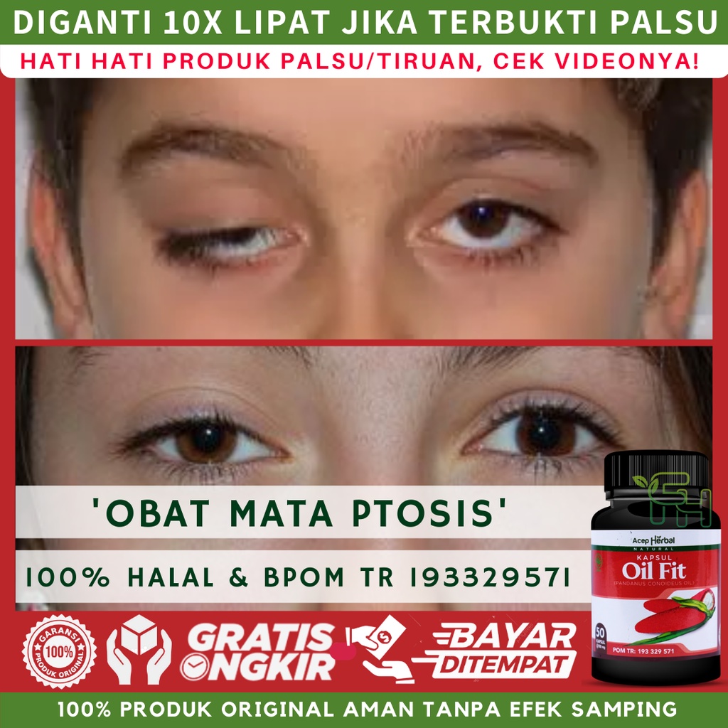 Jual Obat Alami Mata Ptosis Obat Kelopak Mata Turun Sebelah Mata Beda Sebelah Mata Sipit Sebelah ...