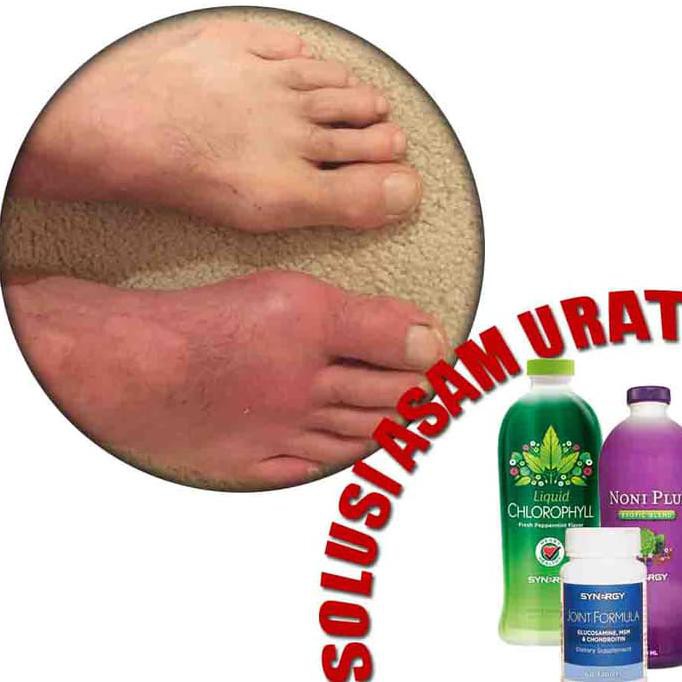 Jual 864U675-A Paket Herbal Obat Asam Urat Mujarab (Klorofil Joint ...