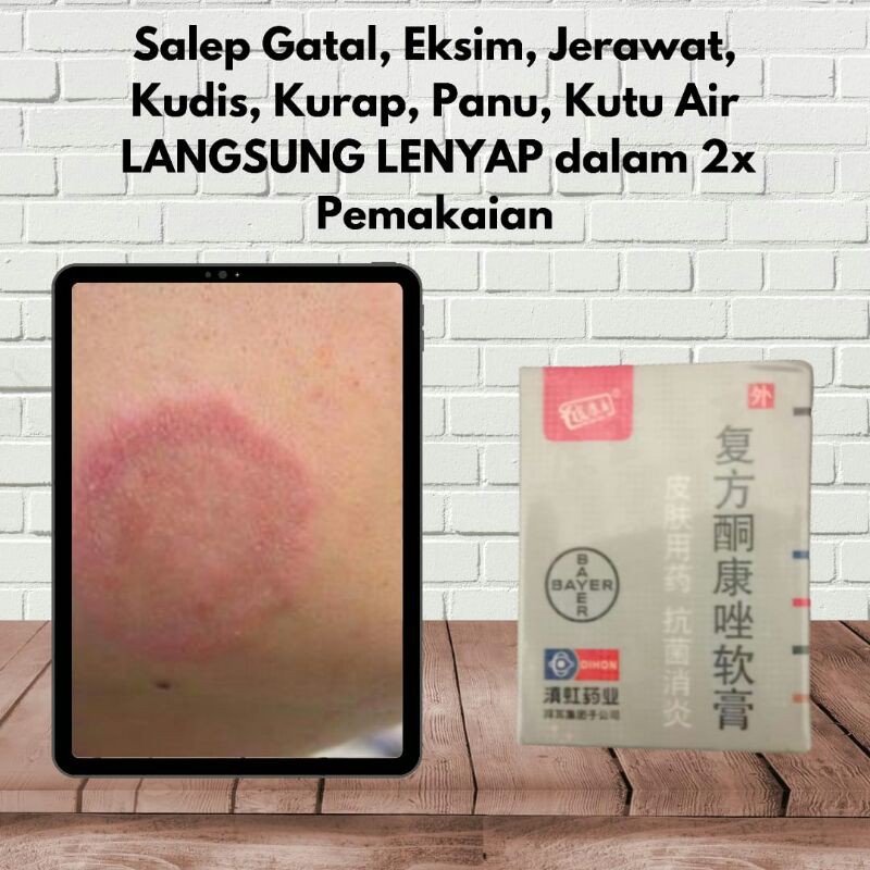 Jual salep obat gata gatal, panu, dl | Shopee Indonesia